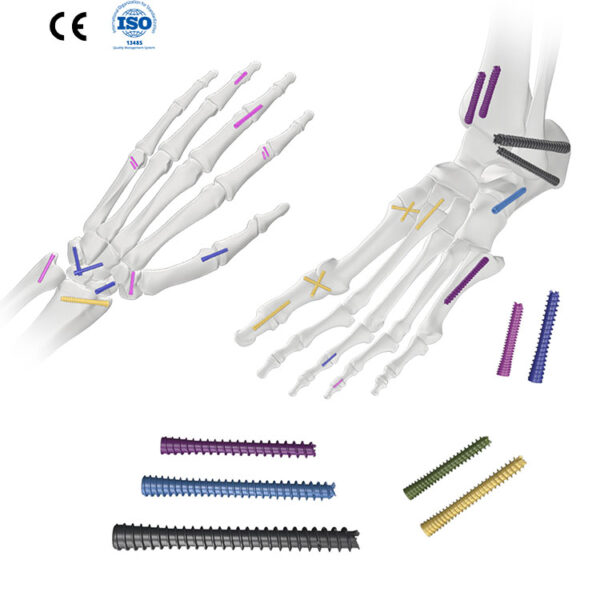 Headless Cannulated Compression Screw for Orthopedic Screws – Twily Med